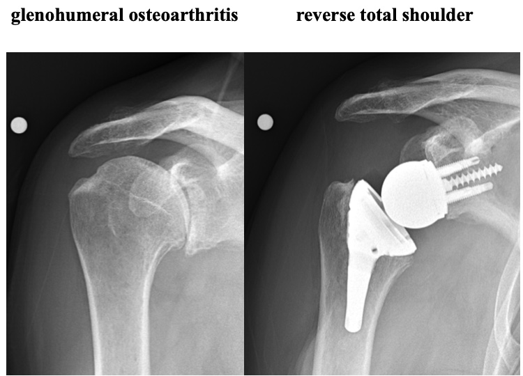 Shoulder Arthritis University Orthopedics